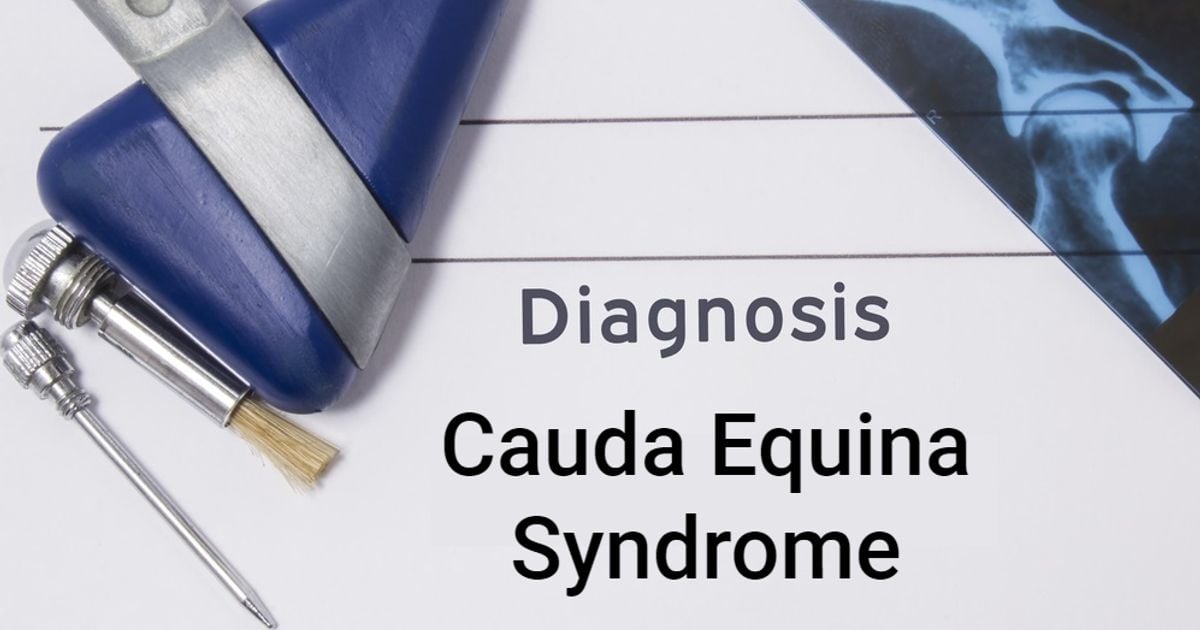 What is Cauda Equina Syndrome? - Facty Health