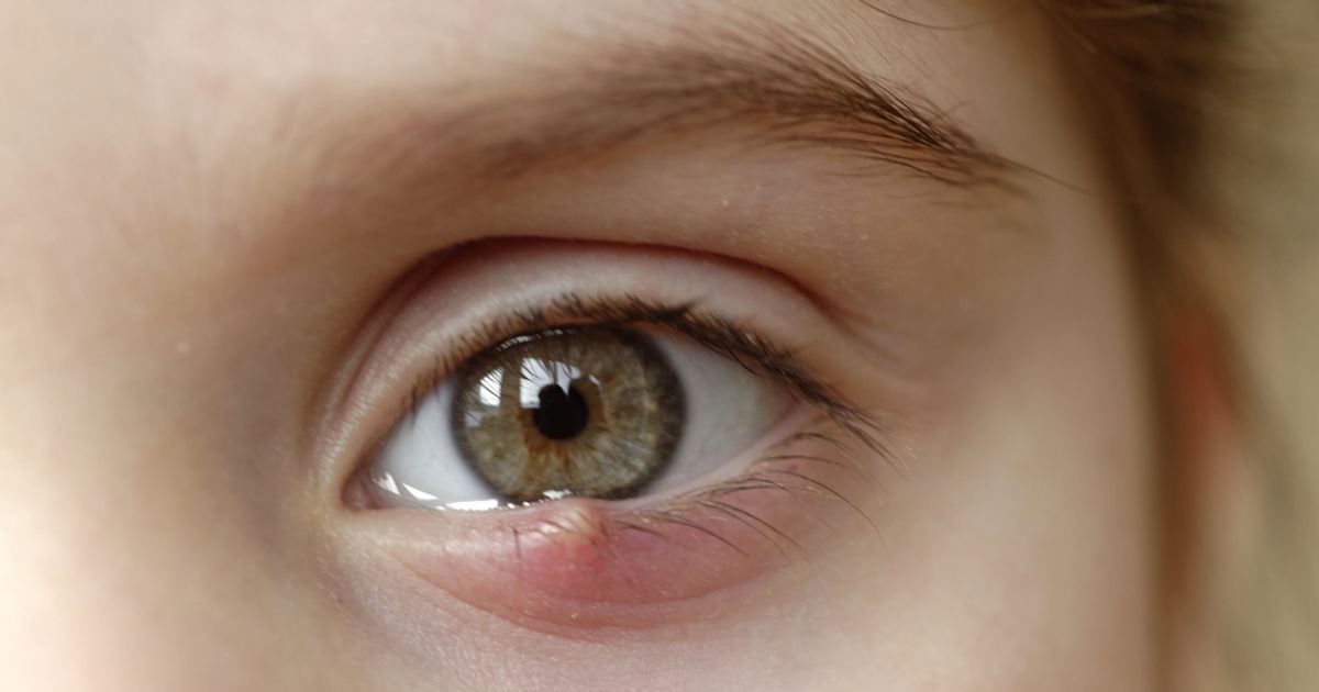 What Causes a Stye? - Facty Health