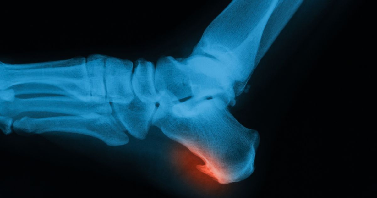 Diagnosis, Causes, and Treatment of Exostosis - Facty Health