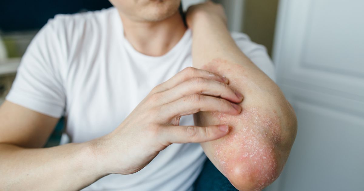 The Ultimate Guide to Eczema - Facty Health
