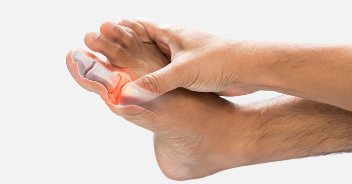 The Ultimate Guide to Gout - Facty Health