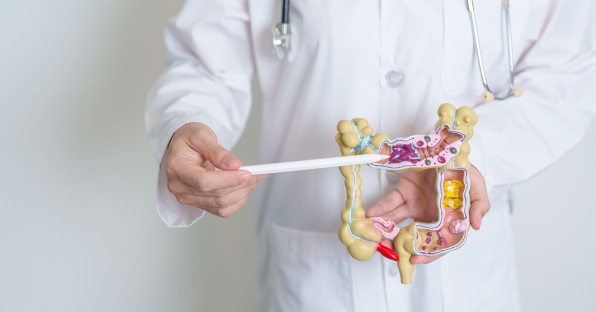 How to Recognize the Symptoms of Colorectal Adenomas - Facty Health