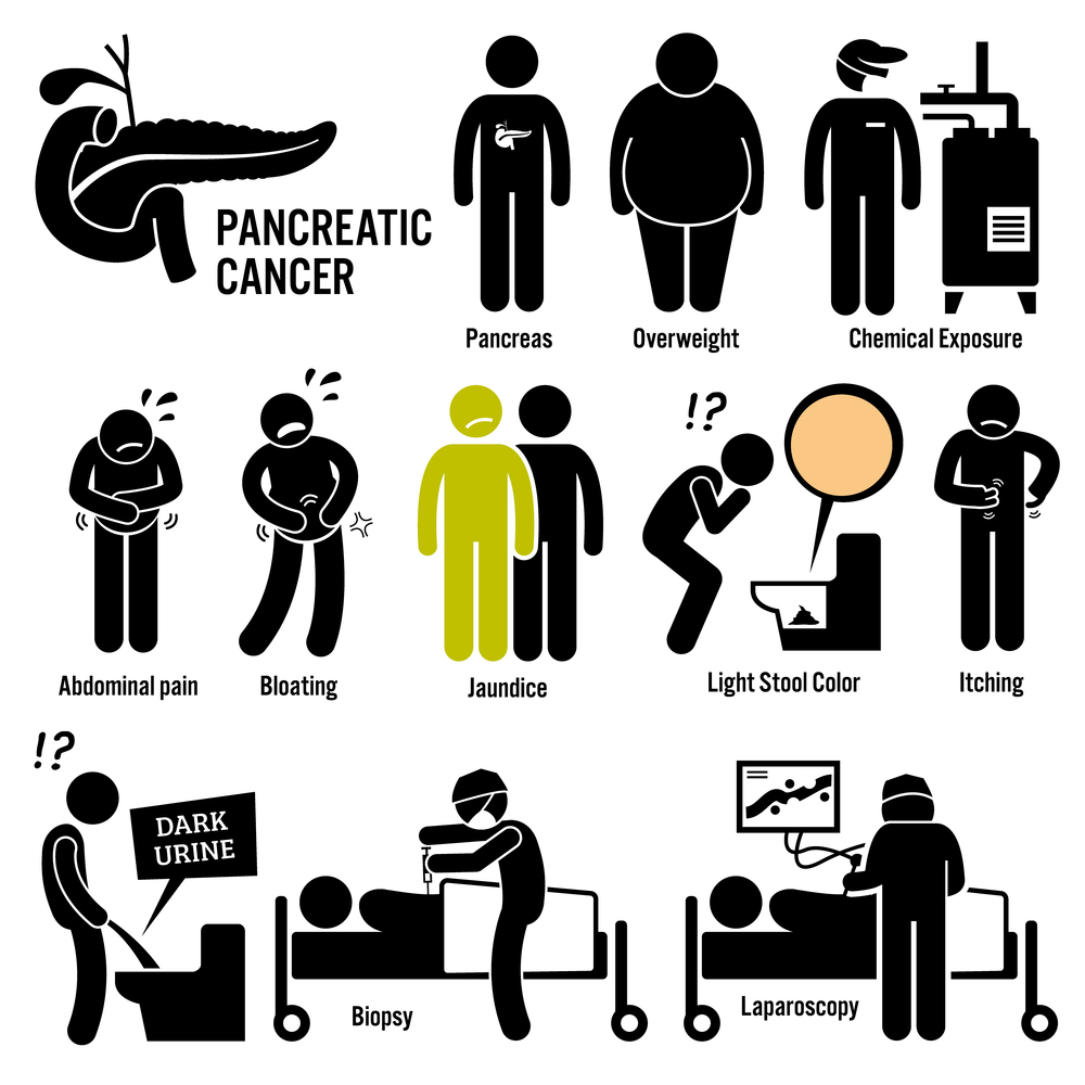 10 Symptoms Of Pancreatic Cancer Facty Health