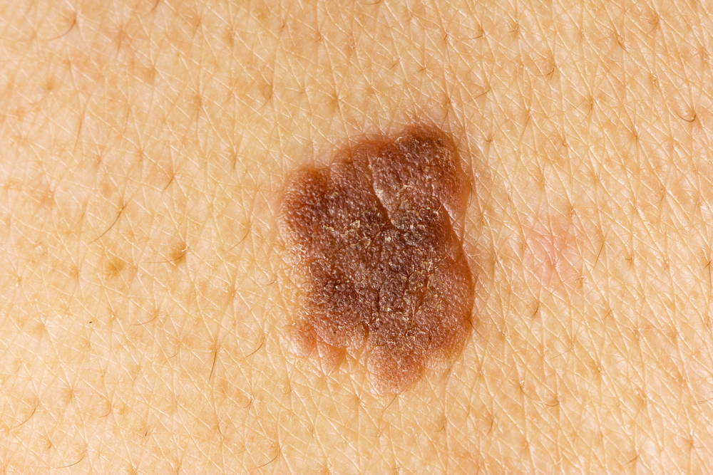 10 Symptoms Of Kaposi Sarcoma Facty Health 10 Symptoms Of Kaposi Sarcoma Facty Health