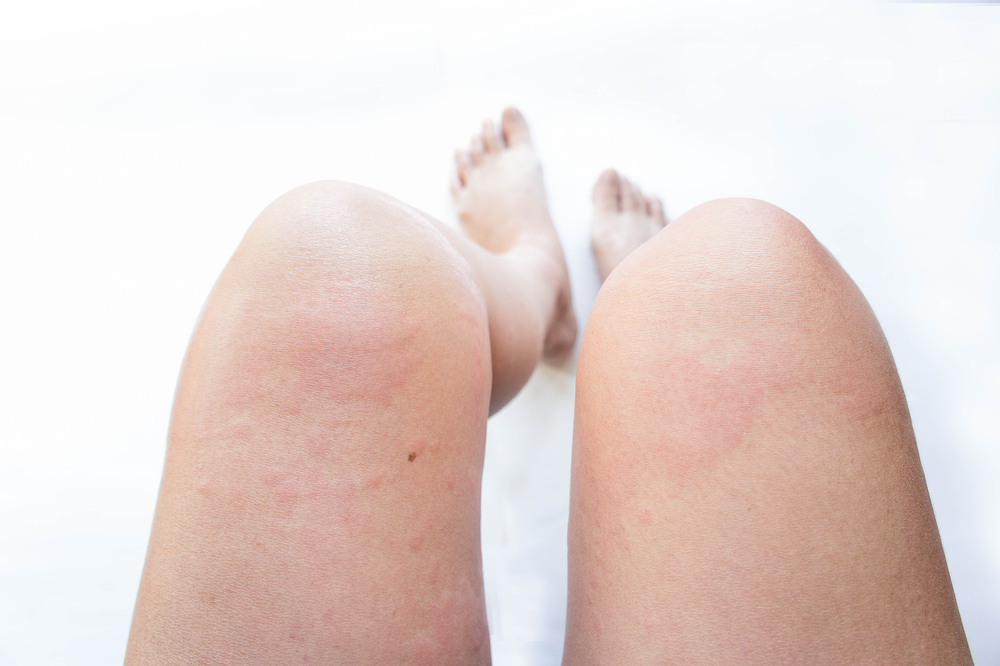 10-symptoms-of-shin-splints-facty-health