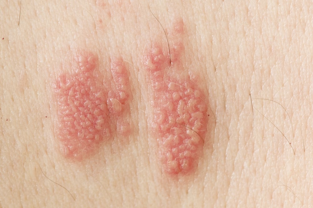 10 Home Remedies for Shingles - Facty Health