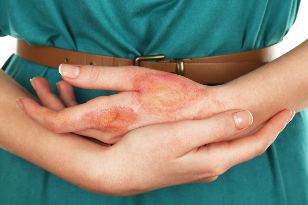 10 Home Remedies for Burns - Facty Health