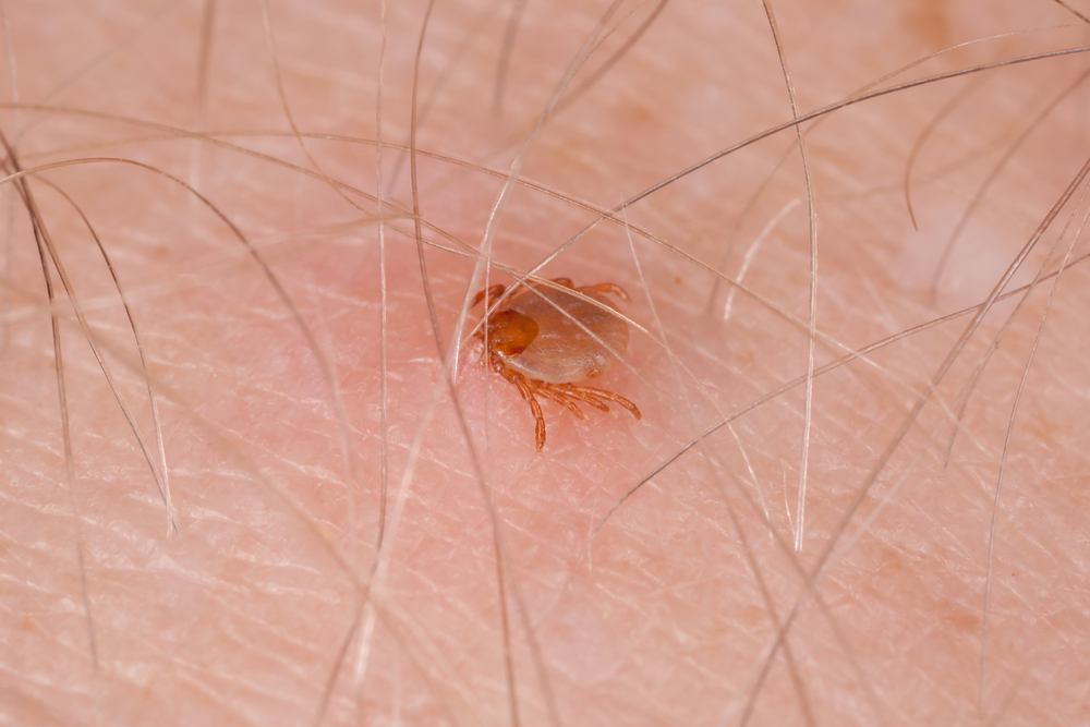 10 Symptoms of Rocky Mountain Spotted Fever - Facty Health