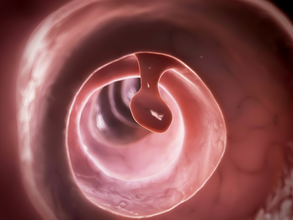 10 Common Colon Polyp Types Facty Health