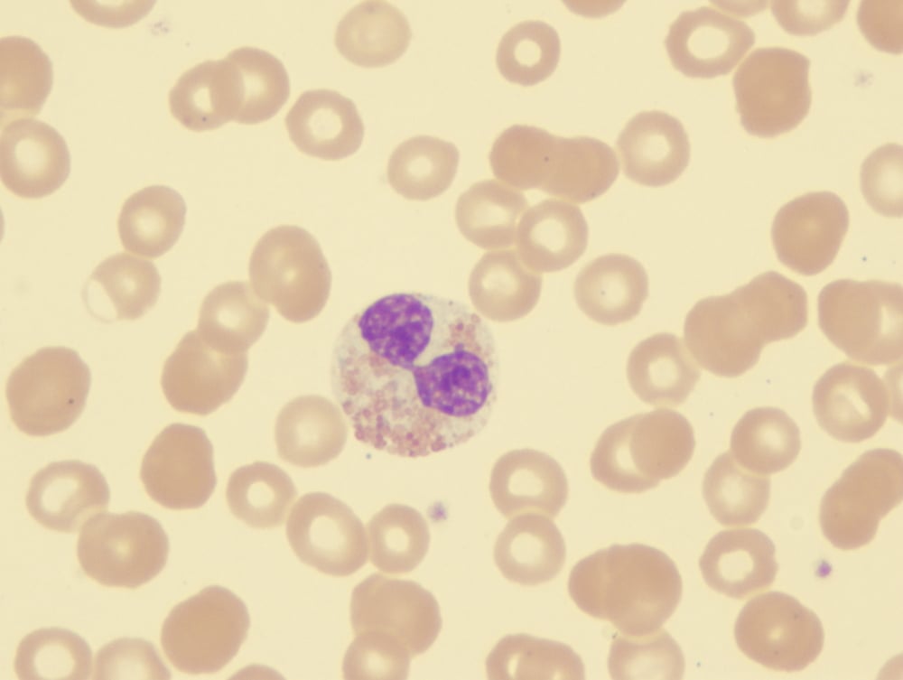 Symptoms and Treatments of Myelodysplastic Syndrome - Facty Health