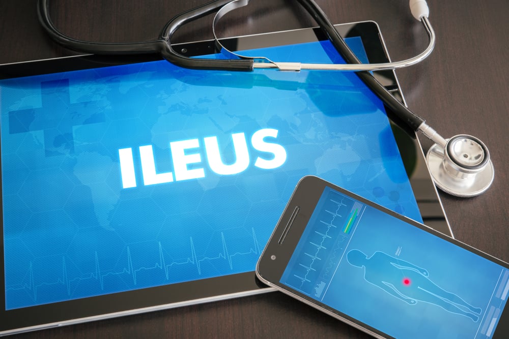 8 Frequently Asked Questions about Ileus - Facty Health