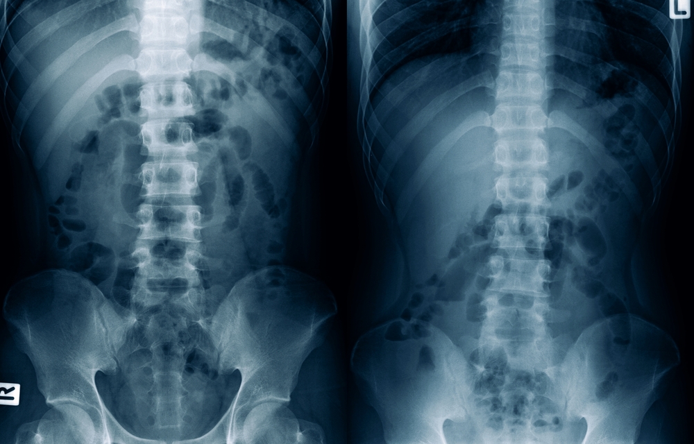 8 Frequently Asked Questions about Ileus - Facty Health