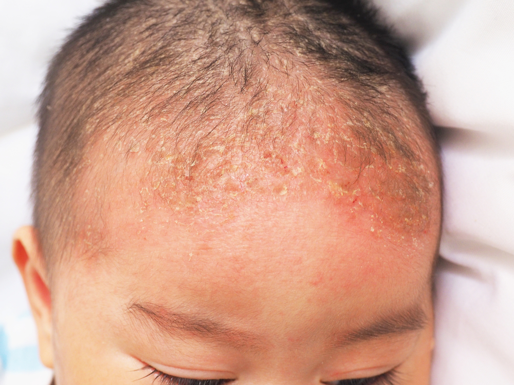 10 Frequently Asked Questions About Cradle Cap Facty Health 10 Frequently Asked Questions About Cradle Cap Facty Health