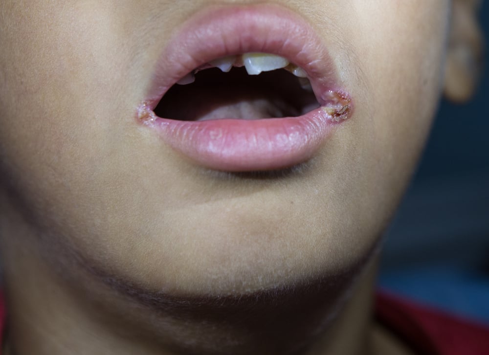 Symptoms, Causes, and Treatments for Milia - Facty Health