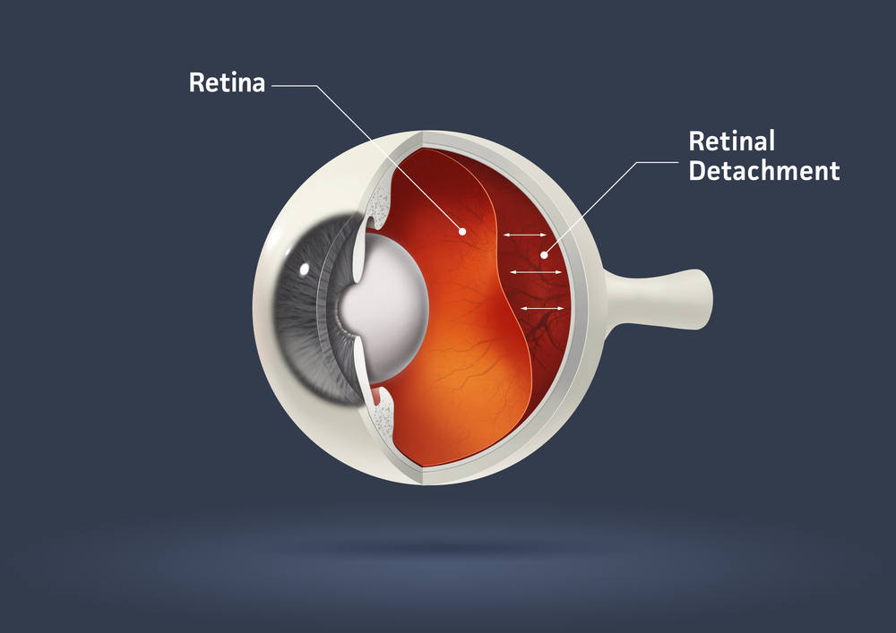 What Is Hemianopia Hemianopsia Facty Health What Is Hemianopia Hemianopsia Facty Health