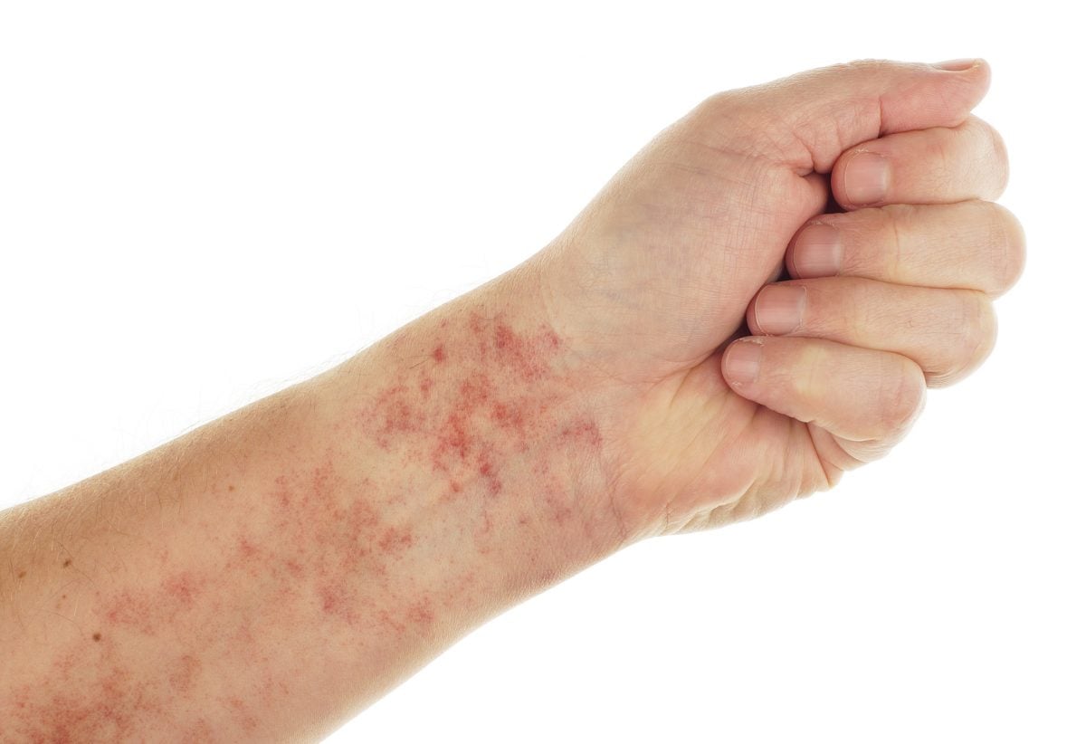 Niacin Flush Skin