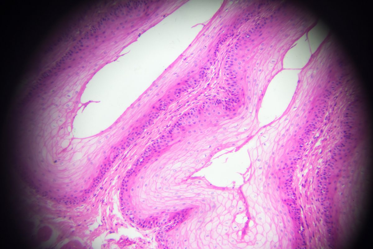 Squamous Epithelial Cells In Urine What Does It Mean Microscopic