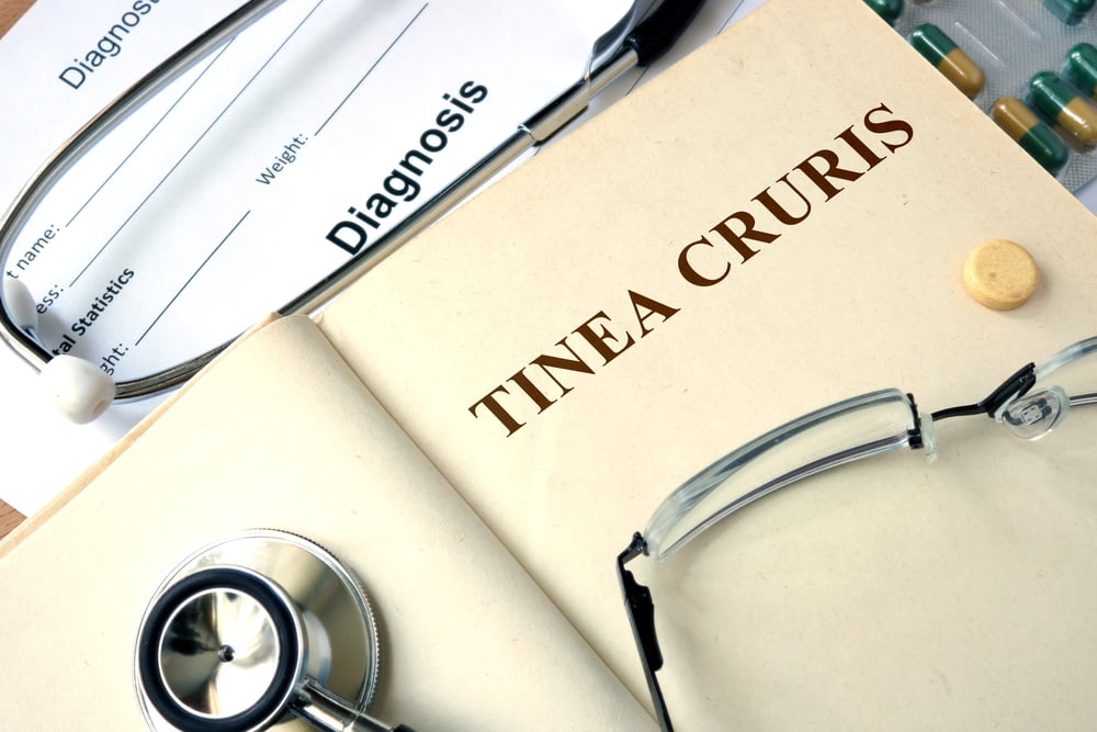 9 Facts About Tinea Cruris - Facty Health