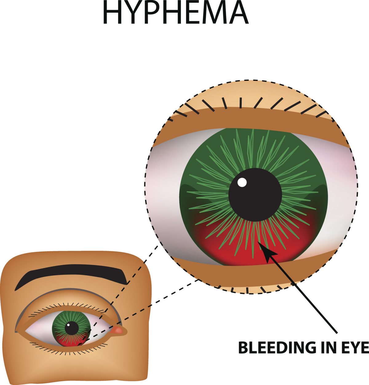 What is Hyphema? - Facty Health