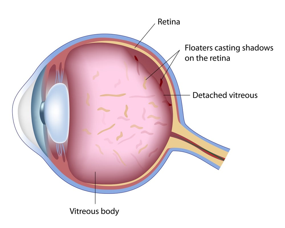 10 Causes and Symptoms of Vitreous Hemorrhage - Facty Health