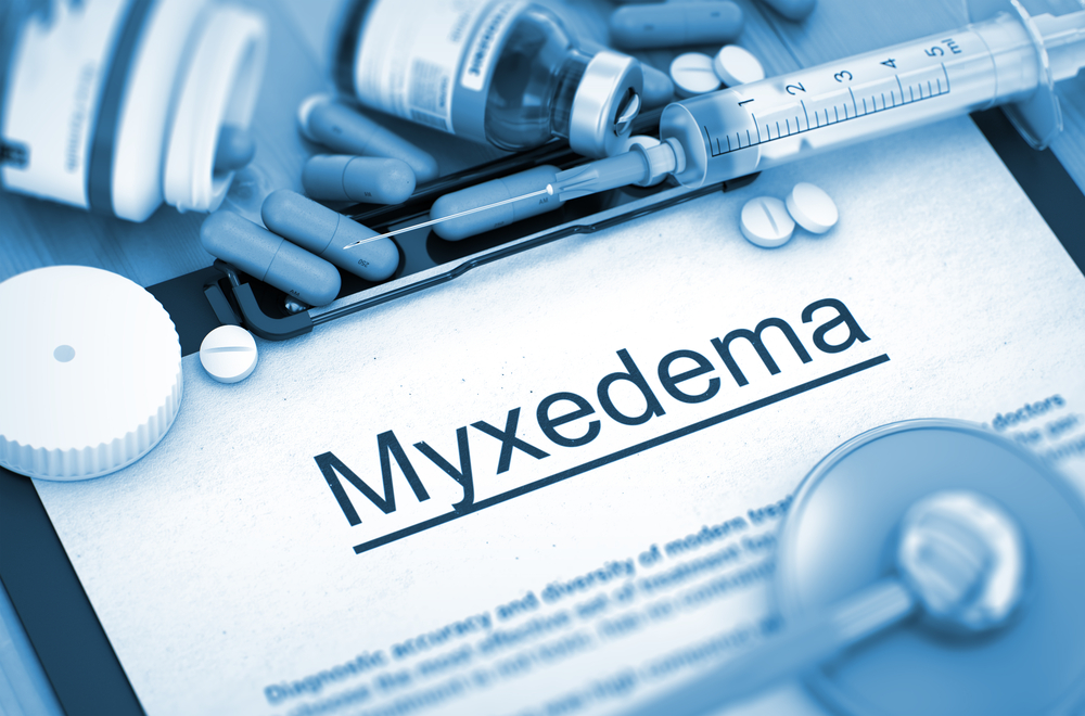 Symptoms and Causes of Myxedema - Facty Health