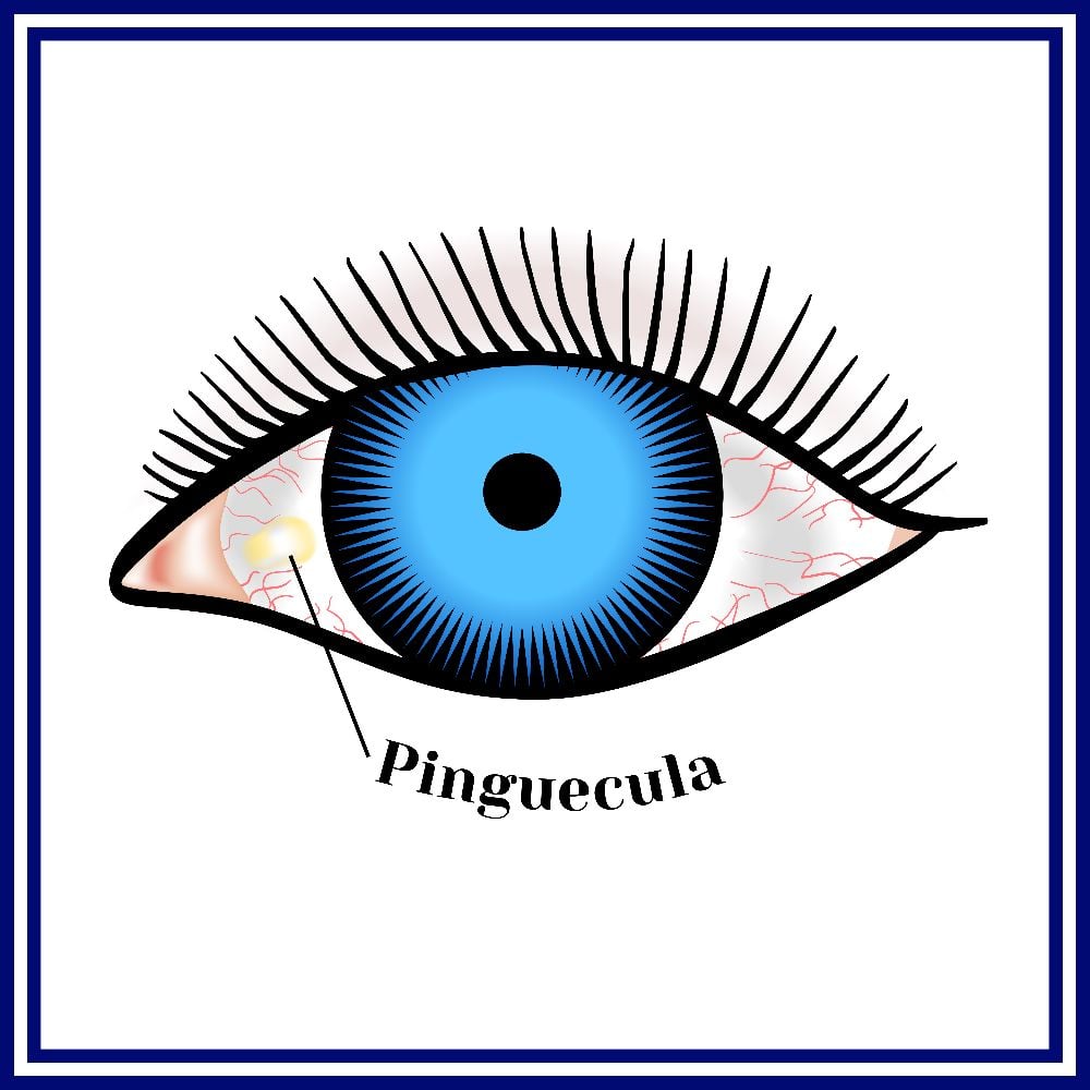 Frequently Asked Questions About Pinguecula - Facty Health