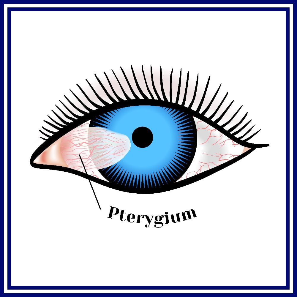 Frequently Asked Questions About Pterygium - Facty Health