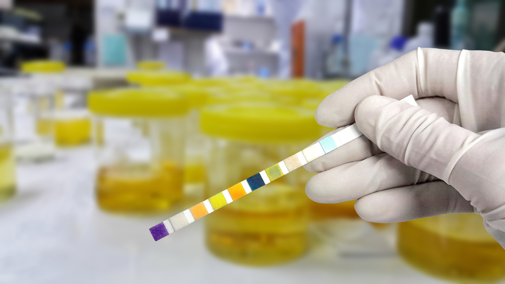 White Blood Cells Or Leukocytes In Urine Facty Health white-blood-cells-or-leukocytes-in-urine-facty-health