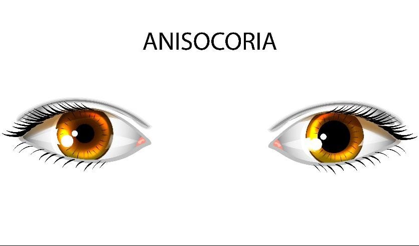 What is Anisocoria? - Facty Health