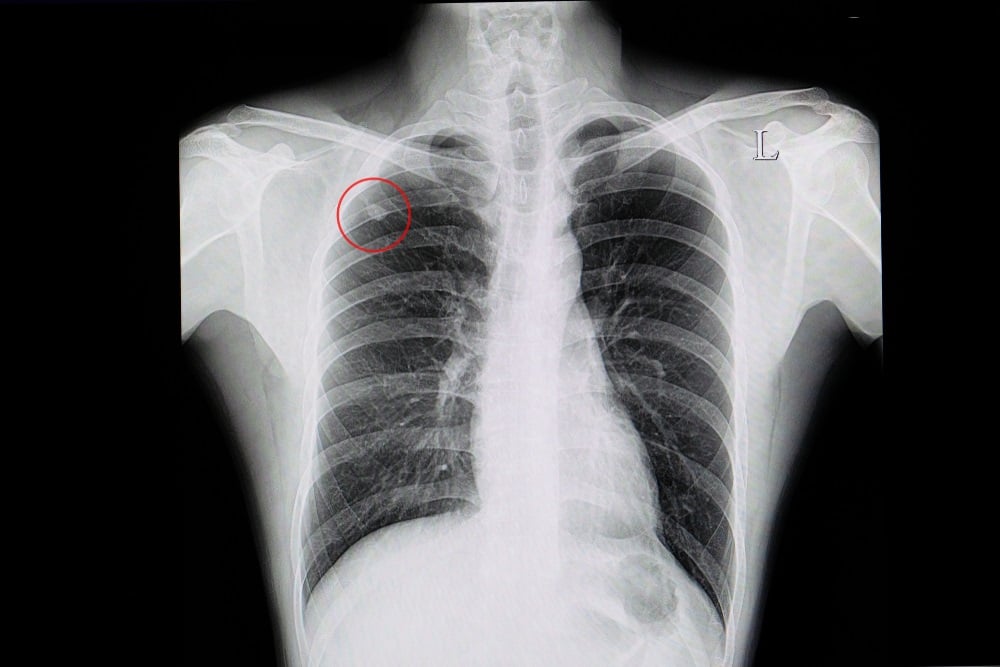 10 Steps for Identifying and Treating Pulmonary Nodules - Facty Health