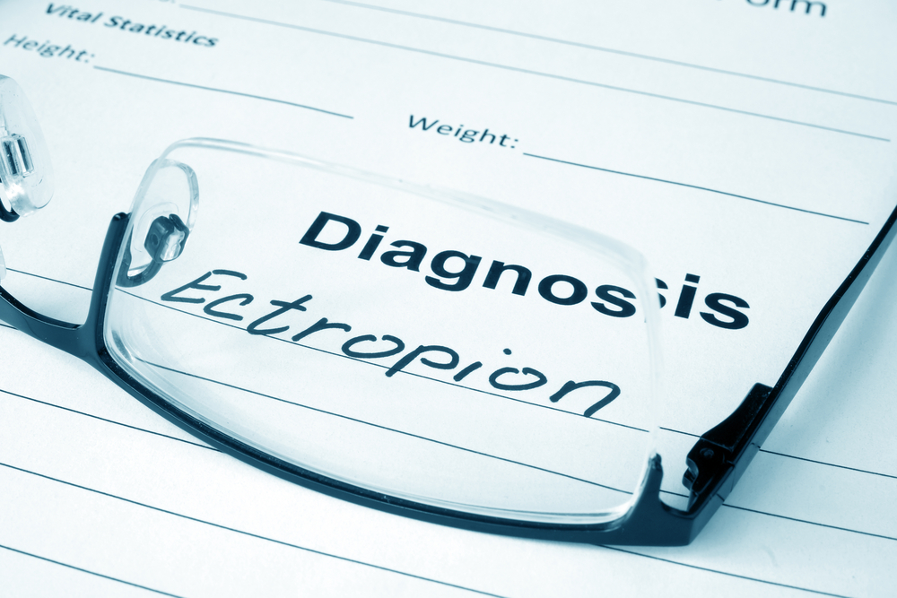 10 Facts About Ectropion - Facty Health