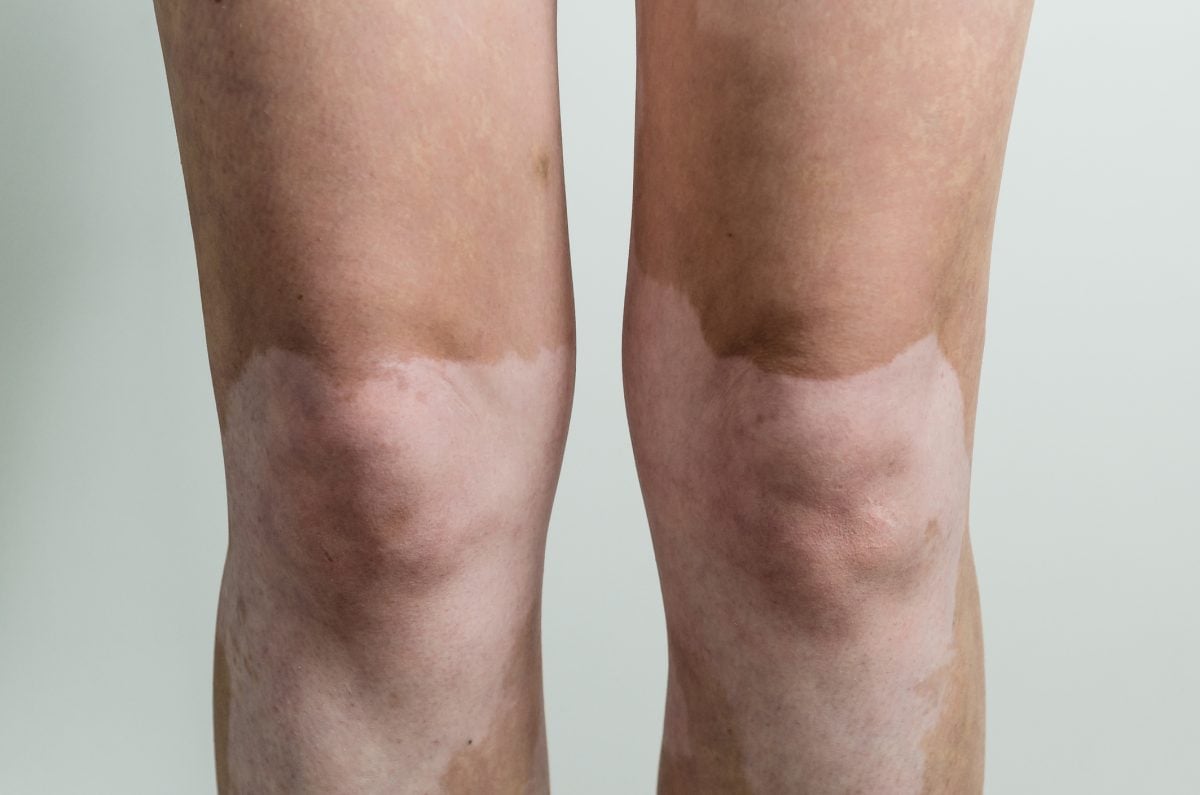 What Causes White Patches On The Skin Facty Health what-causes-white-patches-on-the-skin-facty-health