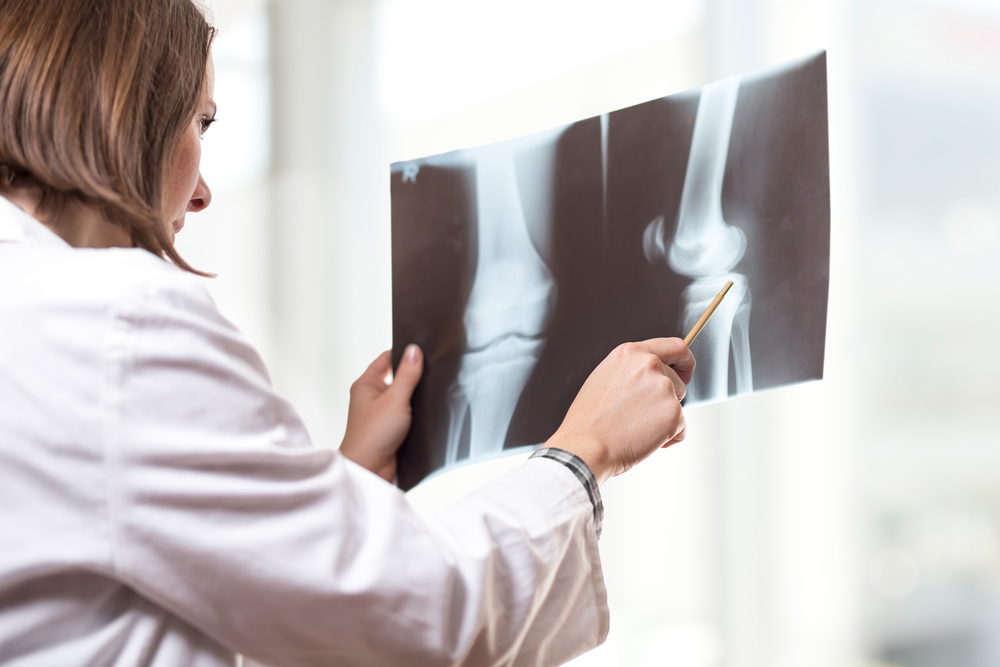 Causes, Symptoms, and Treatments of Avulsion Fractures - Facty Health