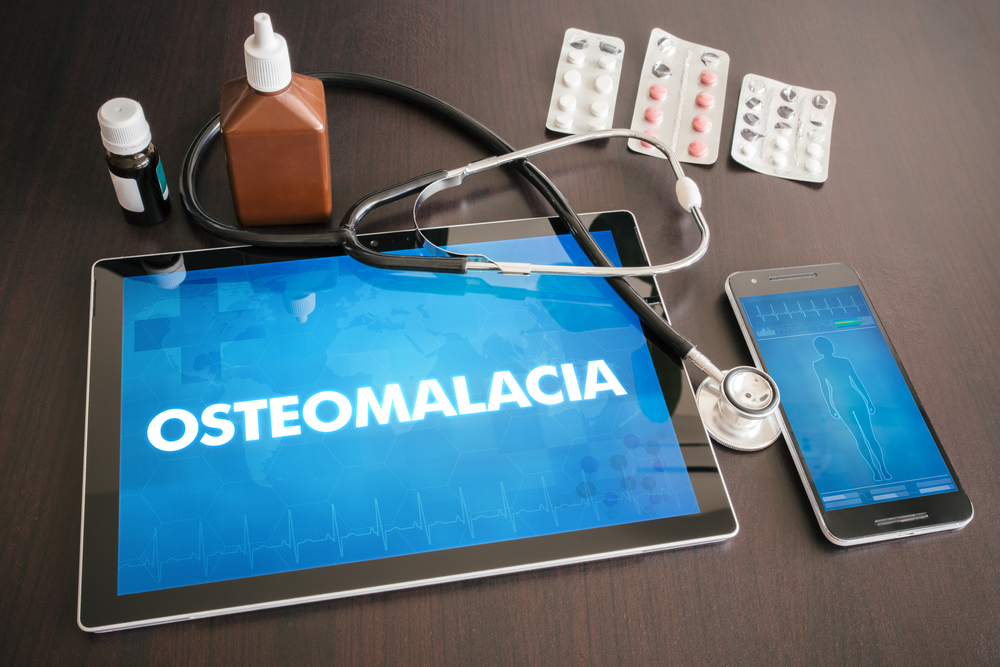 10 Important Facts About Osteomalacia - Facty Health