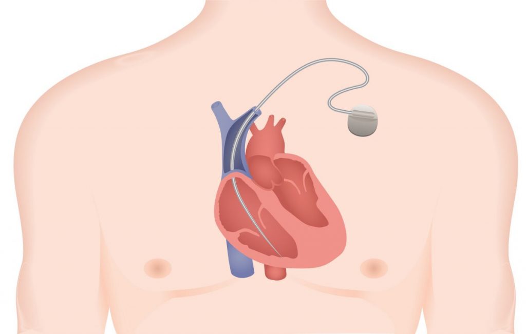 How Do Pacemakers Work? - Facty Health How Do Pacemakers Work? - Facty Health