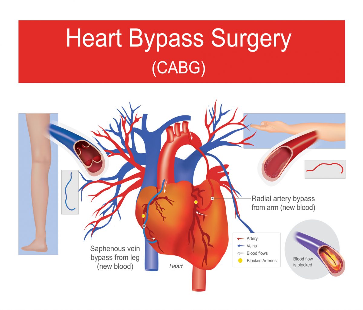 Radial Artery Understanding Transradial Cardiac Catheterization