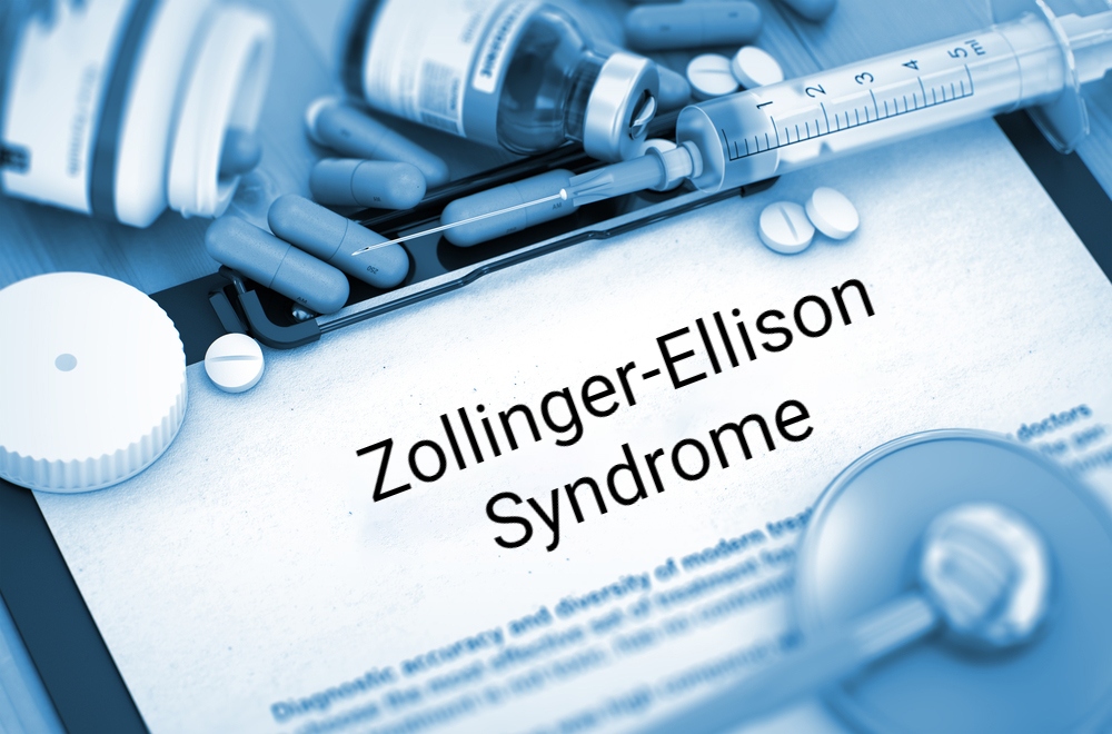 Zollinger Ellison Syndrome Treatment Zollinger Ellison Syndrome: What