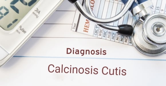 How Doctors Treat These 5 Types of Calcinosis Cutis - Facty Health