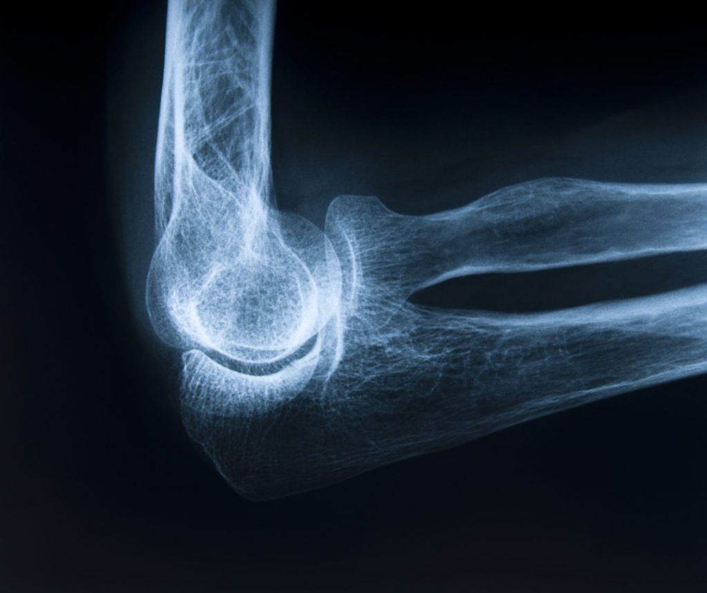 Enthesopathy Causes Tendon or Ligament Pain - Facty Health