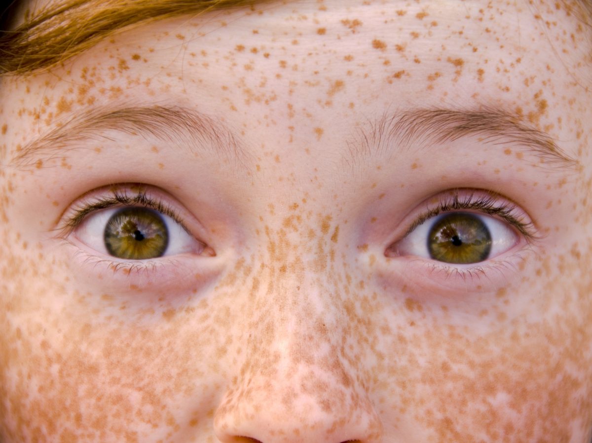 Hyperpigmentation and the Role of Melanin - Facty Health