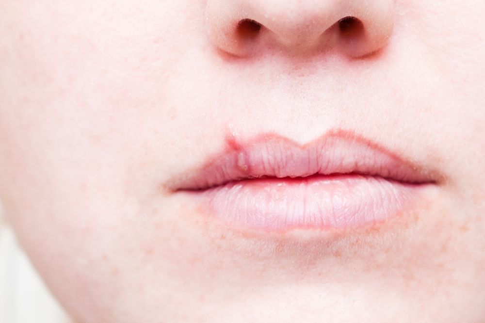 The Stages of a Cold Sore - Facty Health