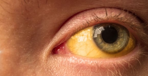 Medical Causes of Yellow Eyes - Facty Health