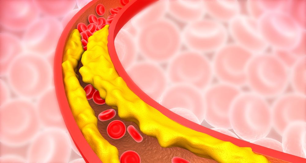 Understanding and Combating Arteriosclerosis - Facty Health