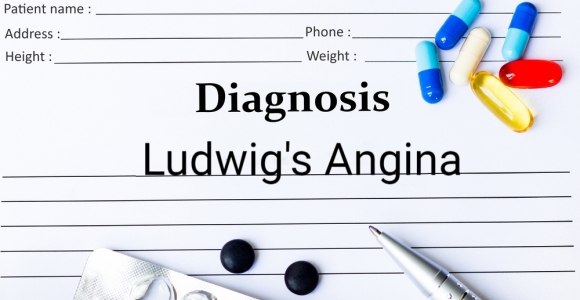 Understanding, Treating, and Preventing Ludwig's Angina - Facty Health