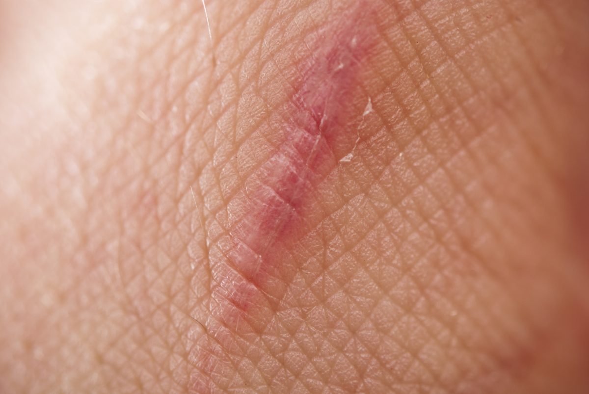 Types Of Scar Tissue And How To Prevent Them Facty Health Types Of Scar Tissue And How To Prevent Them Facty Health