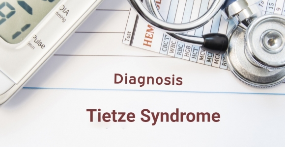 Tietze Syndrome: A Rare Inflammatory Disorder - Facty Health