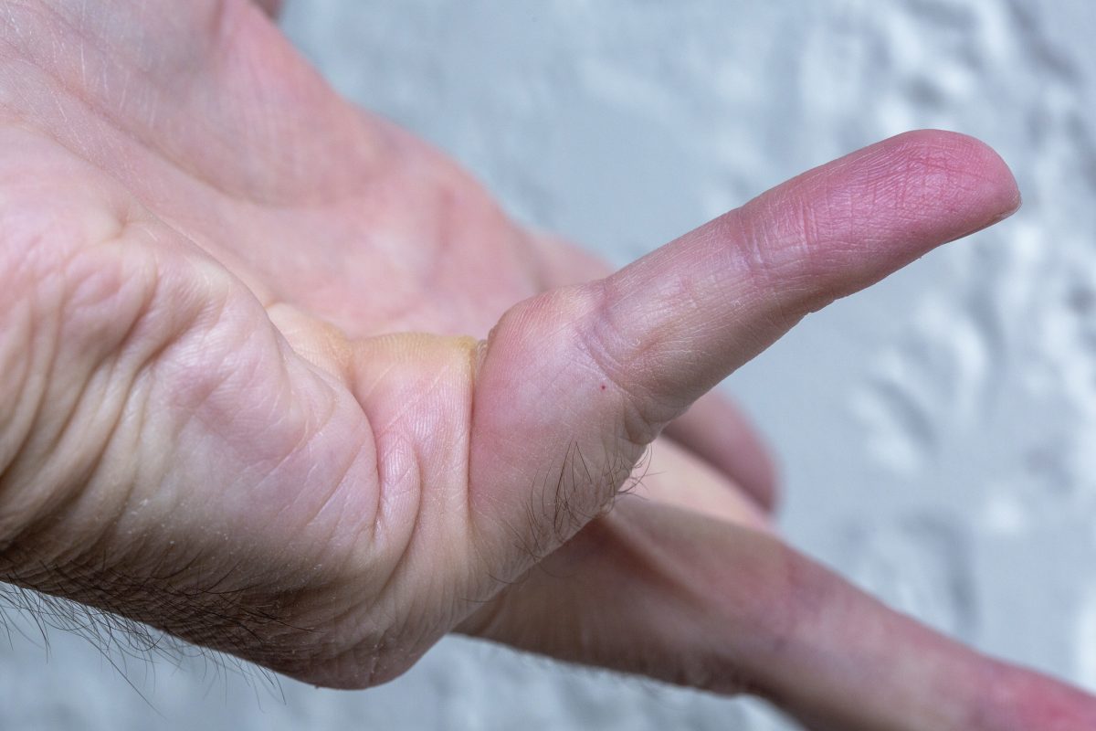 Contracture And Its Many Causes Facty Health