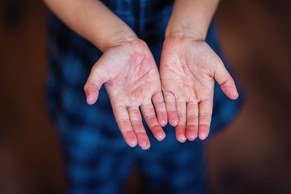 What Causes a Maculopapular Rash? - Facty Health