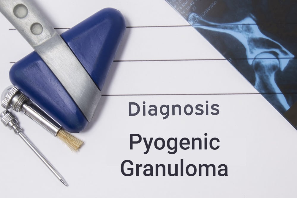 Pyogenic Granuloma: A Common Vascular Tumor - Facty Health