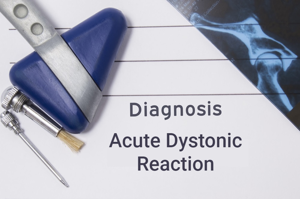 Acute Dystonic Reaction Causes, Symptoms, and Treatment - Facty Health